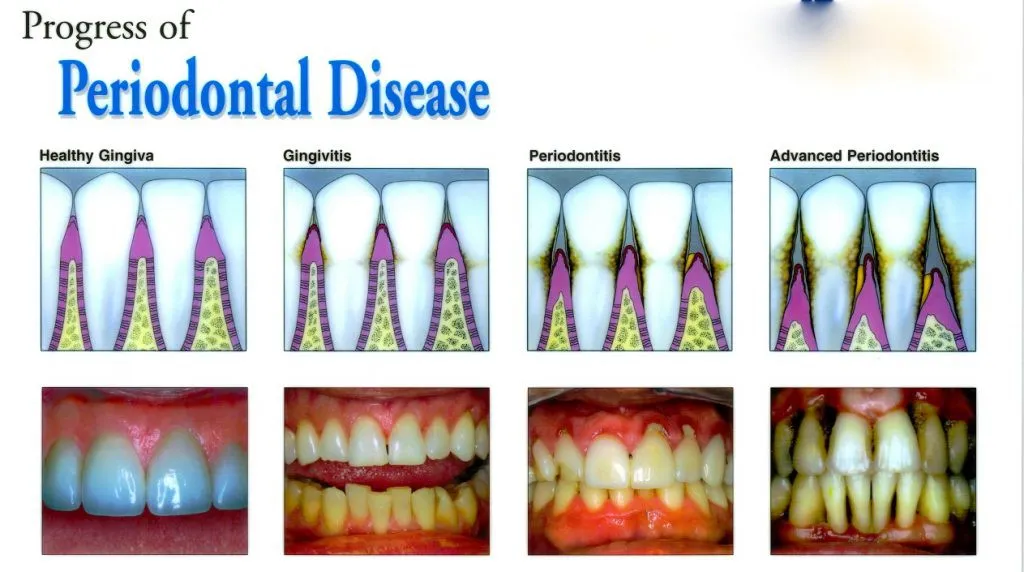 Periodontal Maintenance Lynnwood WA